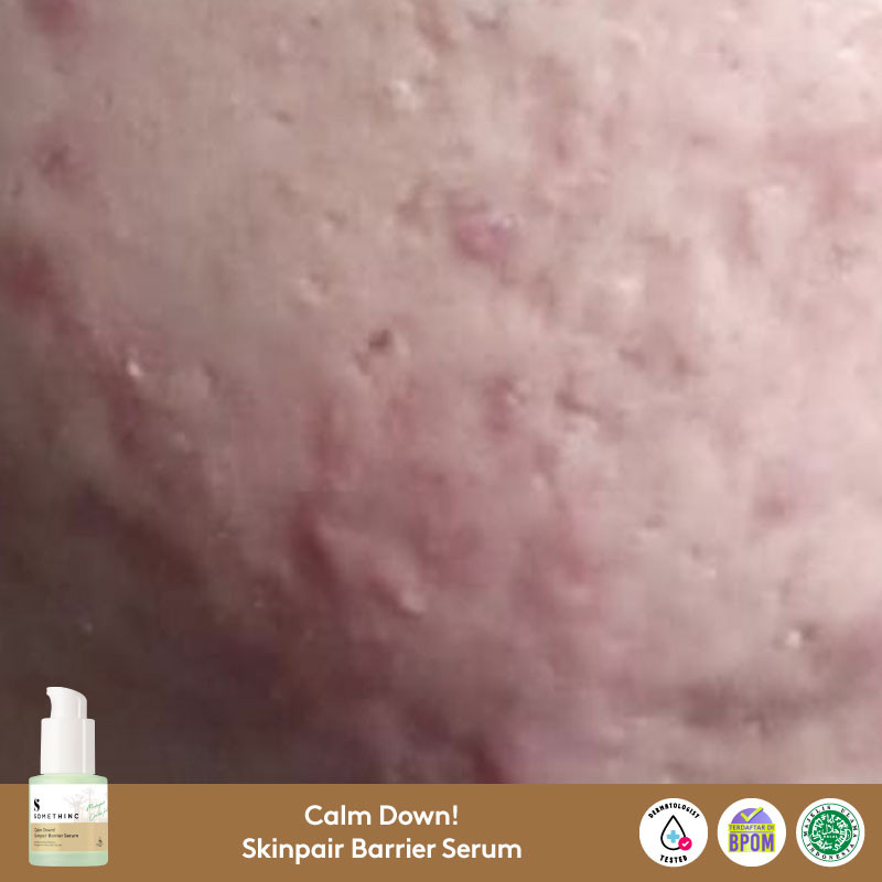 Jual SOMETHINC Calm Down! Skinpair Barrier Serum Original Harga Terbaik