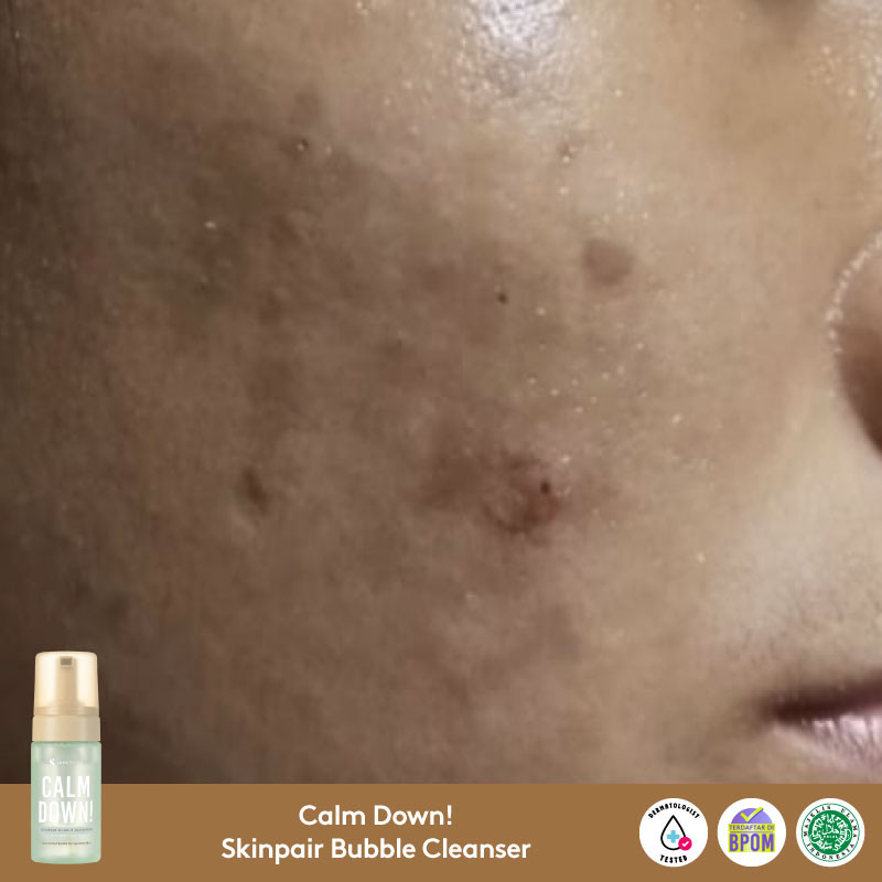 Jual SOMETHINC Calm Down! Skinpair Bubble Cleanser Original Harga Terbaik
