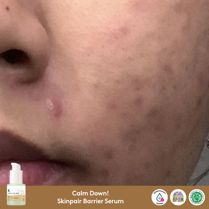 Buy SOMETHINC Calm Down! Skinpair Barrier Serum Original Best Deals