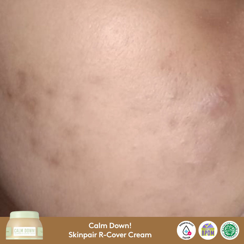 Jual SOMETHINC Calm Down! Skinpair R-Cover Cream Original Harga Terbaik
