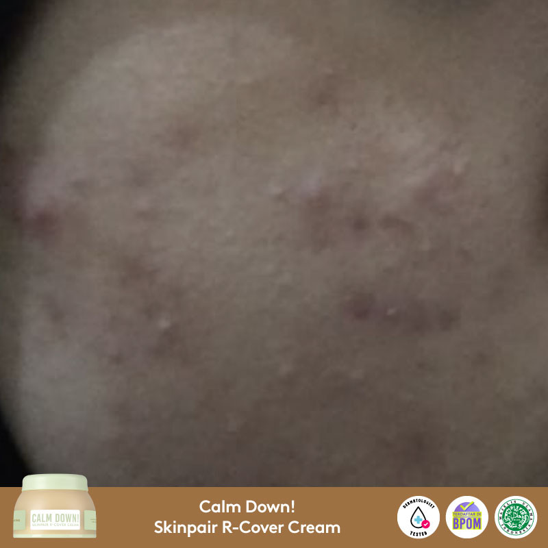 Buy SOMETHINC Calm Down! Skinpair R-Cover Cream Original Best Deals