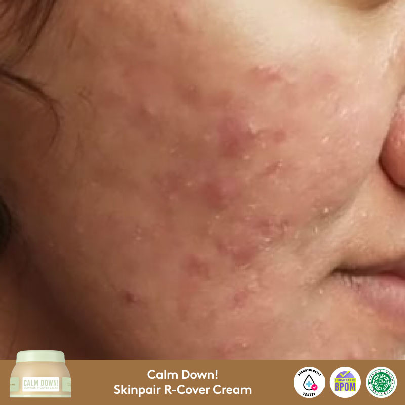 Jual SOMETHINC Calm Down! Skinpair R-Cover Cream Original Harga Terbaik